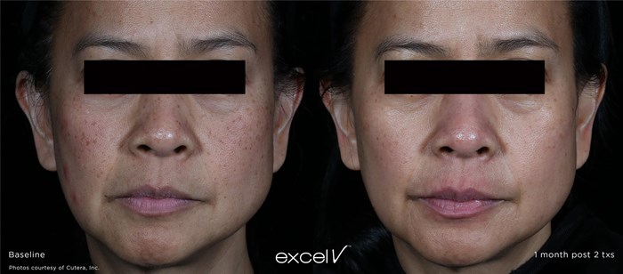excel v-pigment1 - Botox & Dermal Filler in San Antonio | Skin by ...