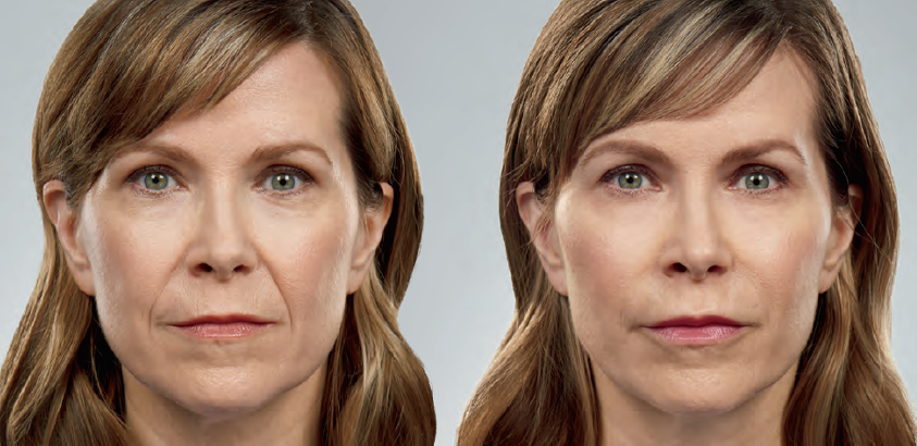 Natural-Filler-Results - Skin by Design Dermatology & Laser Center, PA