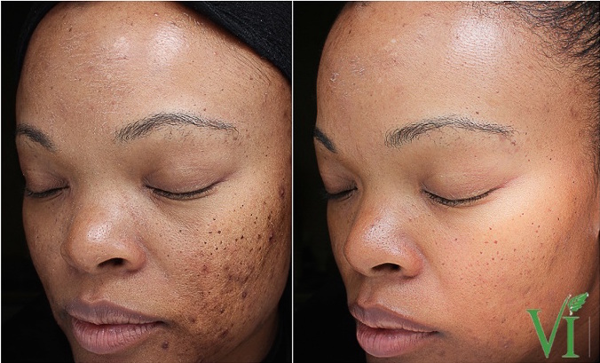 Pigment Issues - Skin by Design Dermatology & Laser Center, PA